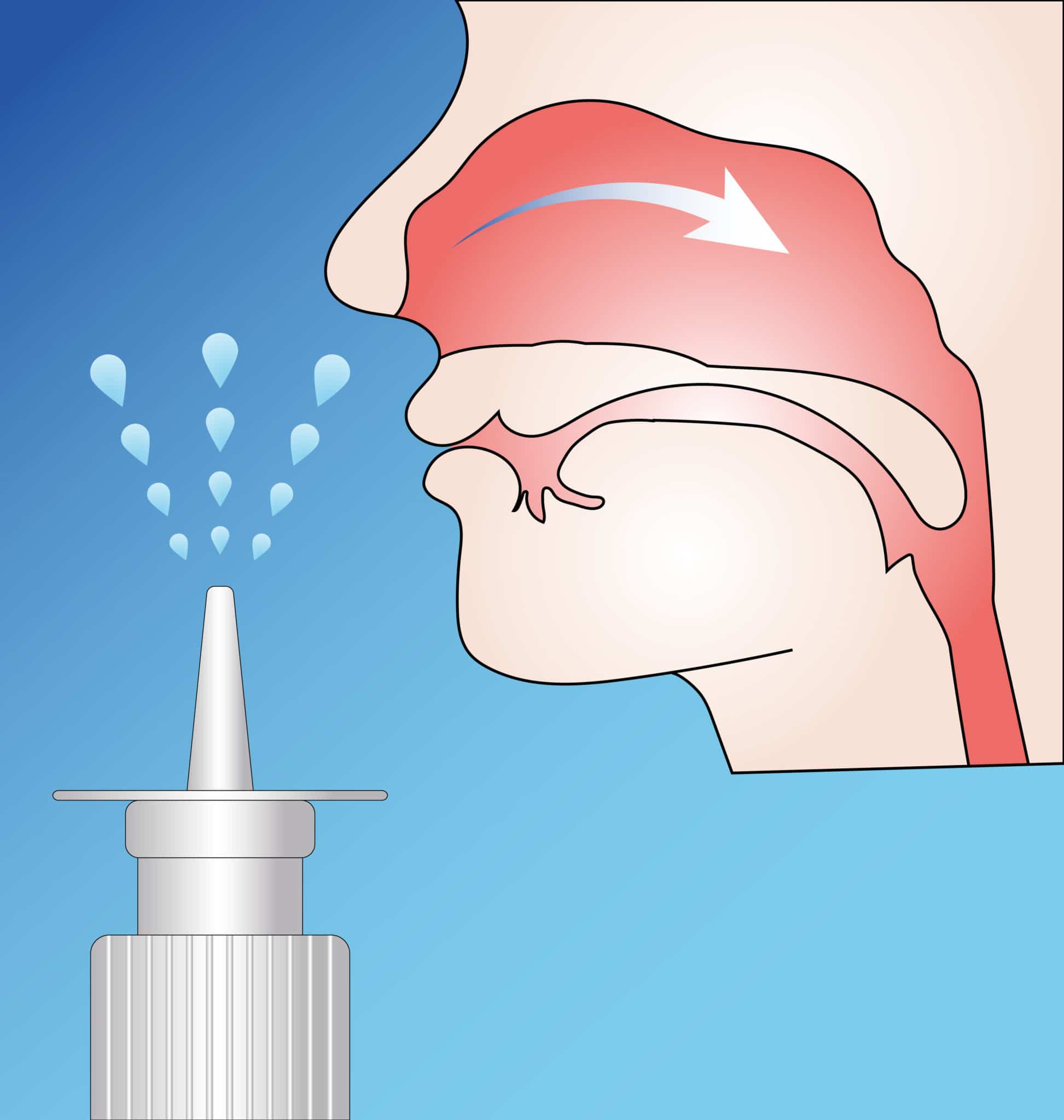 Use of intranasal steroids for rhinitis and sinusitis - Nevada Sinus Relief