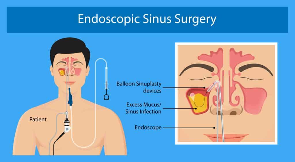 Treatment Options Las Vegas NV - Sinus Treatment Las Vegas