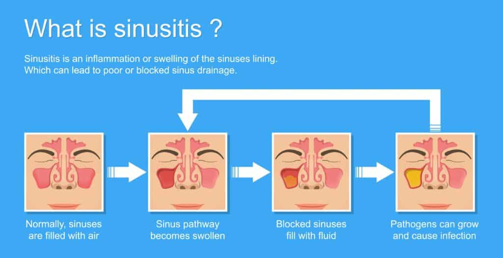 Sinusitis Treatment Las Vegas - Sinus Infection Las Vegas