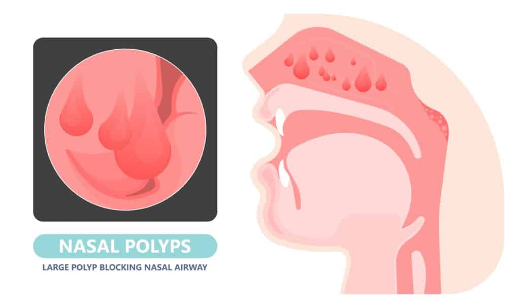 Treatment Options Las Vegas NV - Sinus Treatment Las Vegas