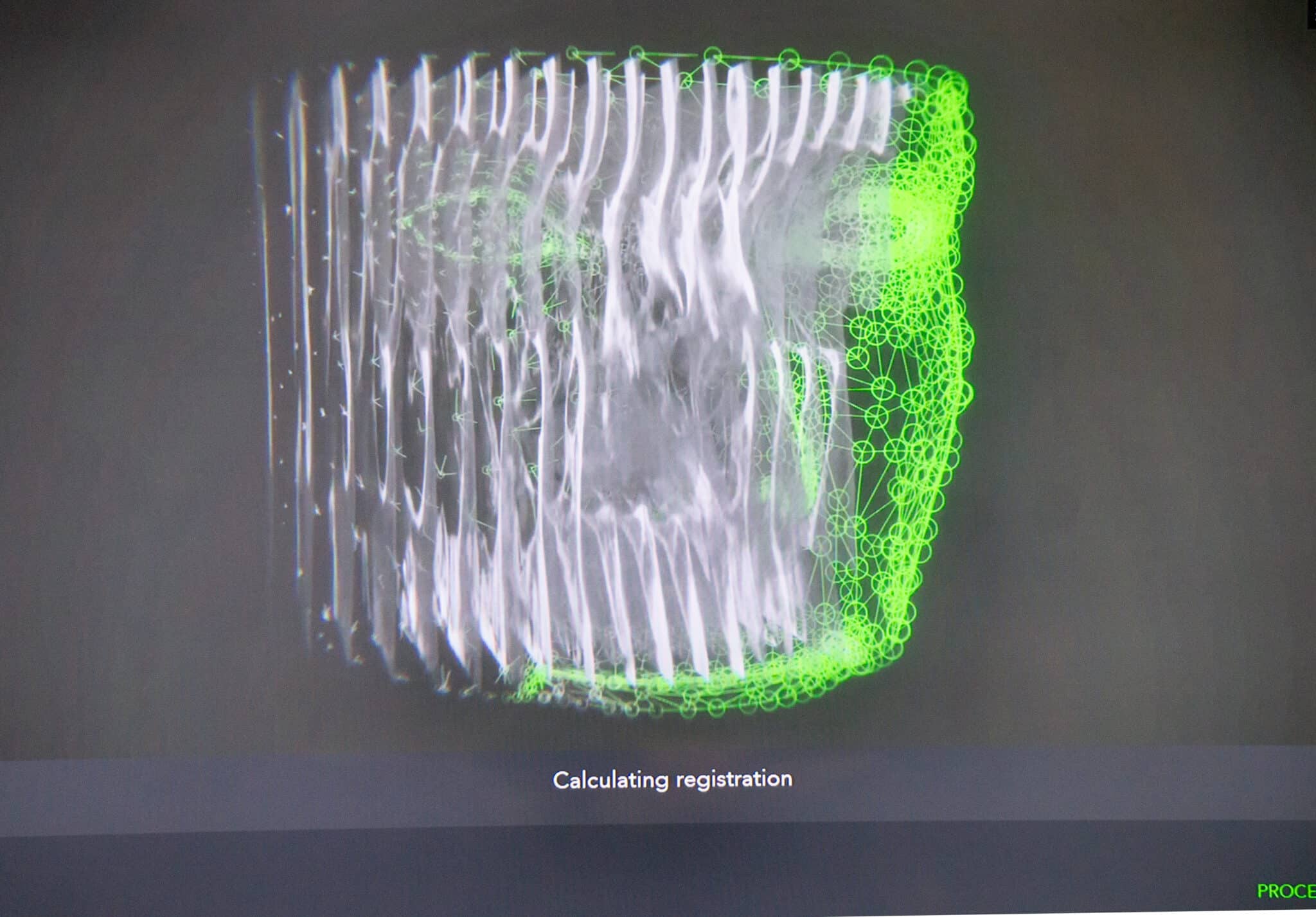 Image Guided Sinus Surgery Las Vegas - Endoscopic Sinus NV