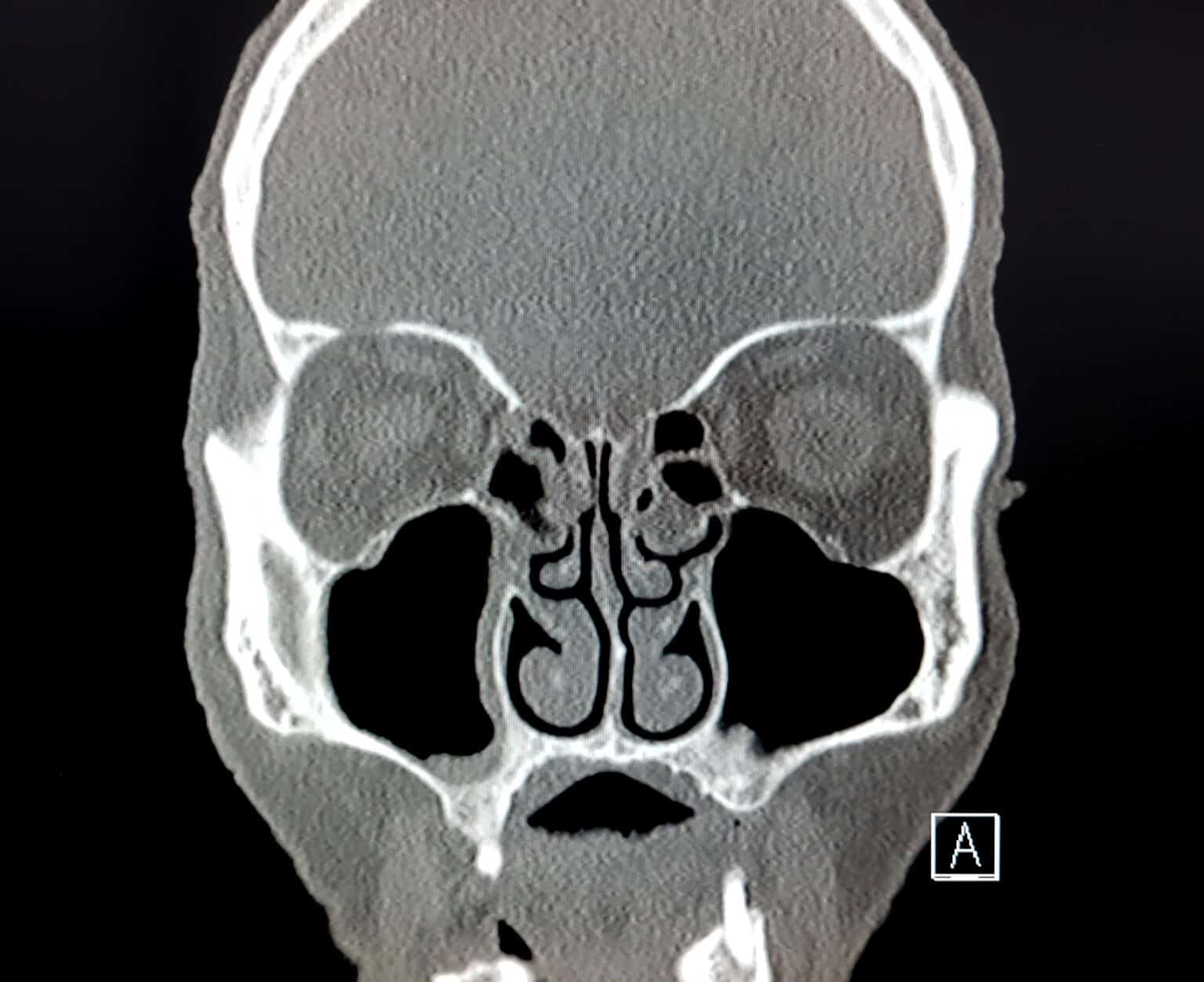 How a Sinus CT Scan Helps Diagnose the Root Cause of Sinusitis